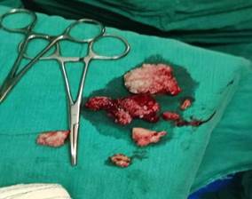 Condiloma gigante en paciente gestante en un hospital público de Paraguay
