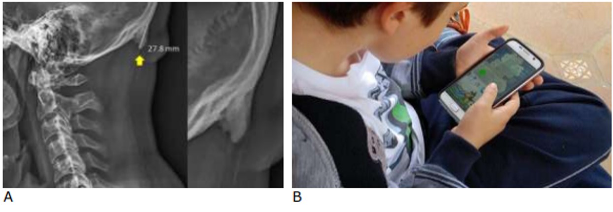 Prevalencia del desarrollo de entesofito en la Protuberancia Occipital ...