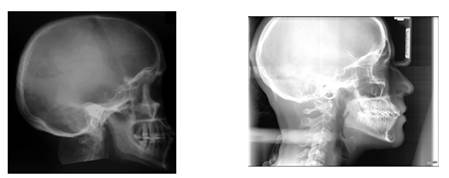 Prevalencia del desarrollo de entesofito en la Protuberancia Occipital ...
